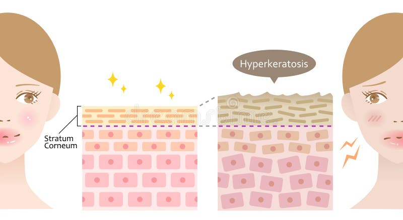 Diagram Of Thickening Of The Stratum Corneum And Woman Face  beauty